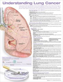 Understanding Lung Cancer Anatomical Chart Laminated | Shop Today. Get ...